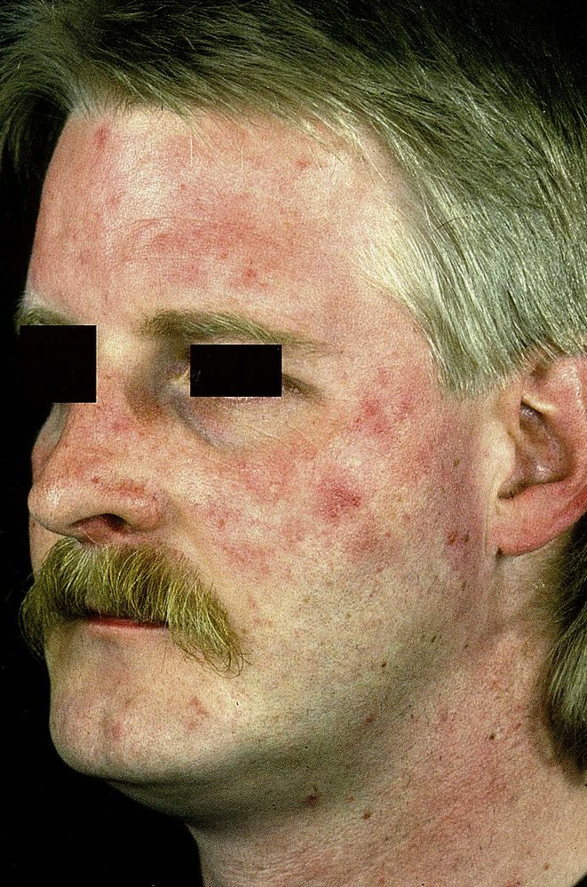 Photodermatitis store