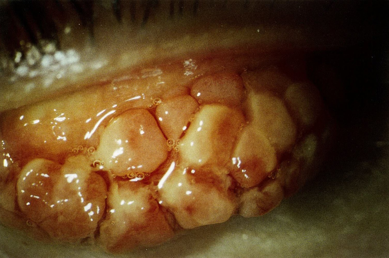 Allergic Conjunctivitis Cobblestone