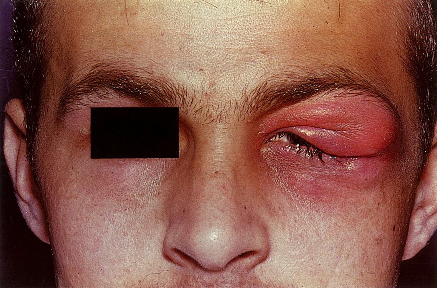 Lacrimal Duct Infection Acute Dacryocystitis Tear Duct Infections In