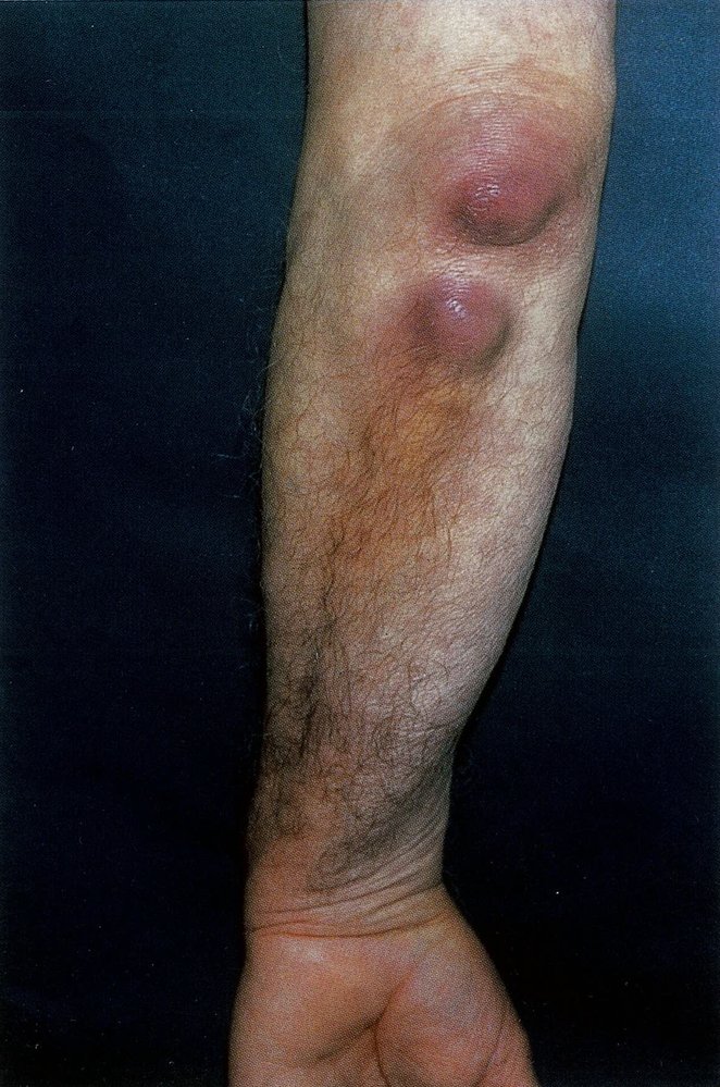 Acrodermatitis Chronica Atrophicans Lyme Disease