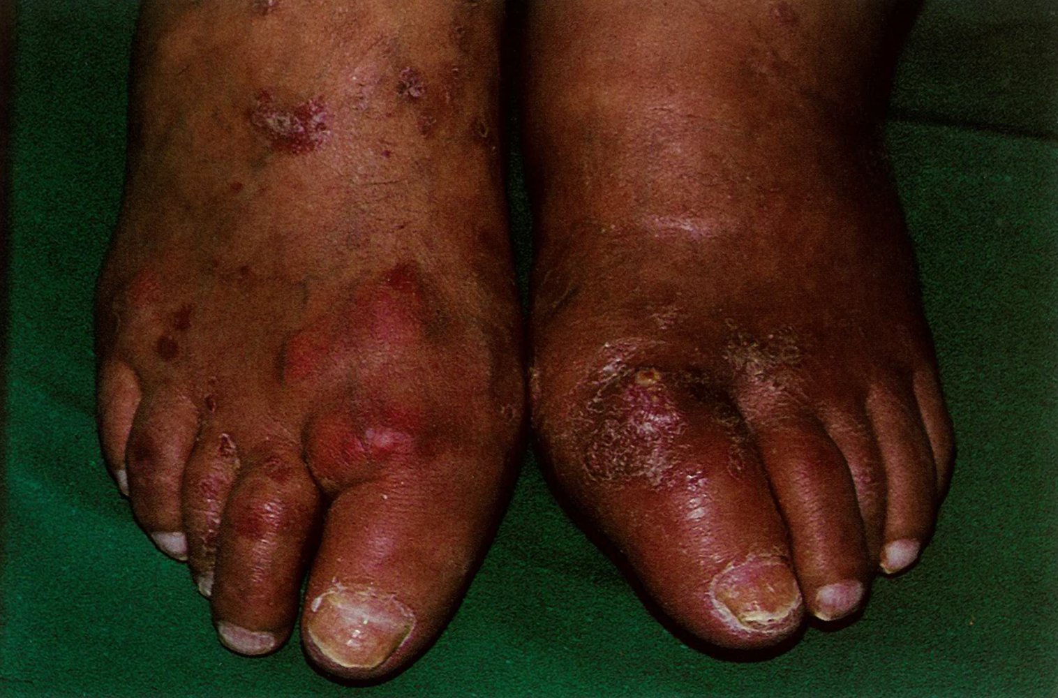 Plethoric Face Polycythemia Vera EM@3AM: Polycythemia EmDocs