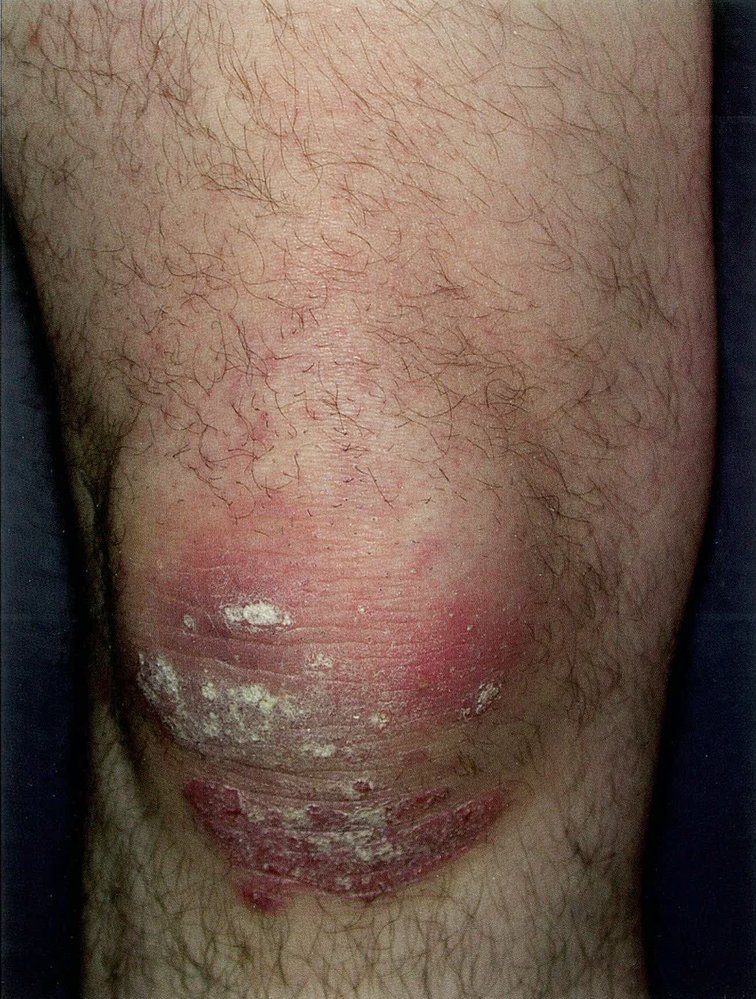 Psoriasis Knee Psoriasis Treatment » A Medical Treatment Abroad