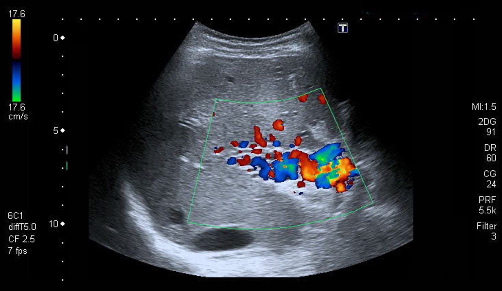 Portal Hypertension Ultrasound View Of Diagnosis And Management Of