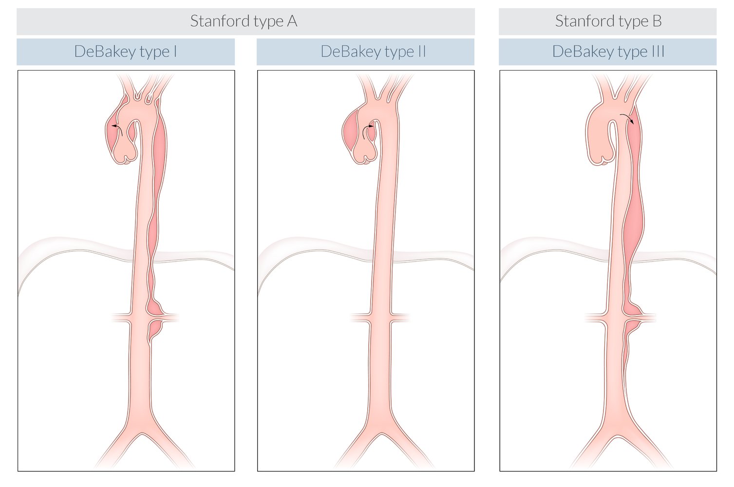 Nephrolithiasis Amboss