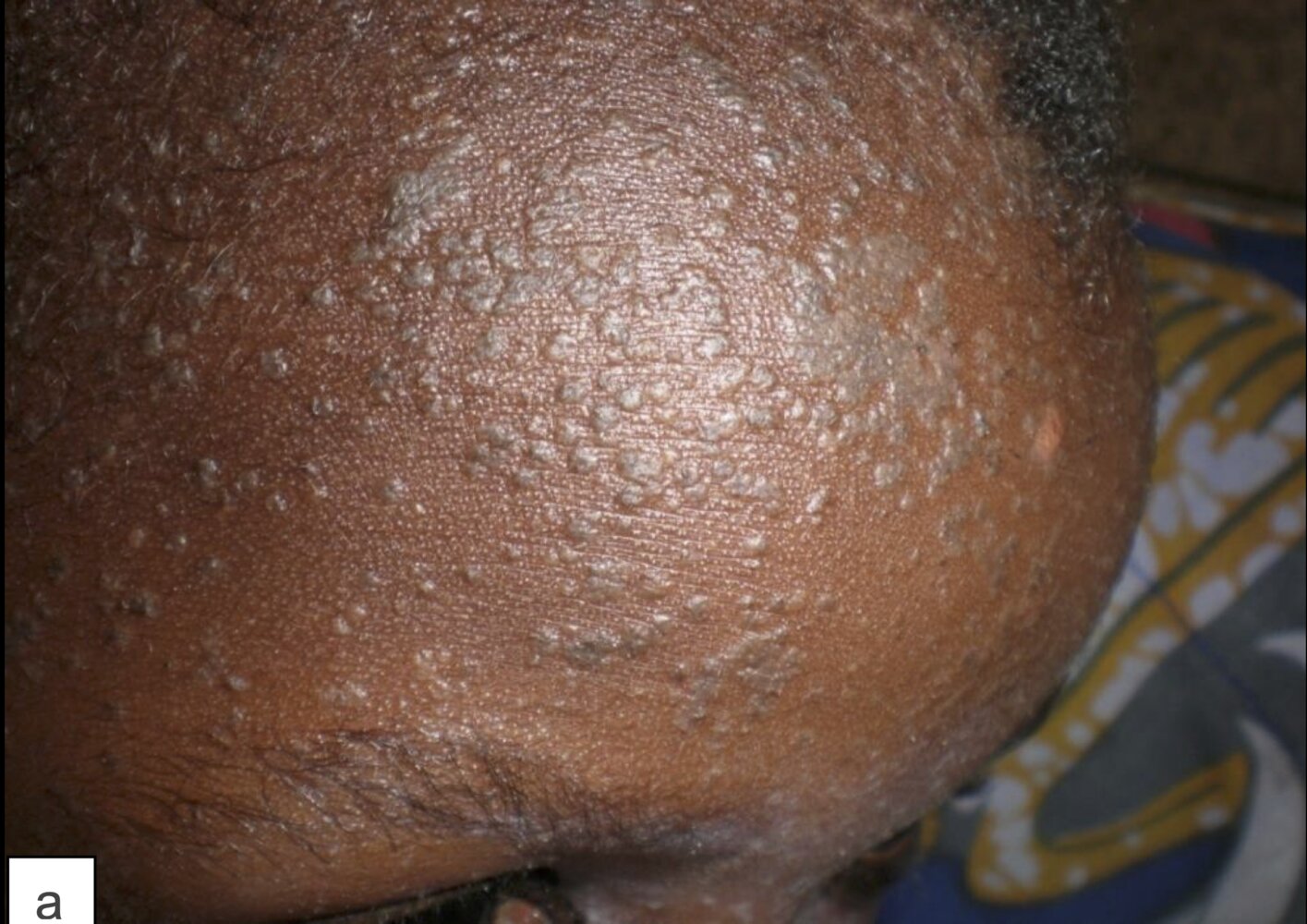 Hpv In Black Men Infections (e.g. HPV) And Cancer | Cancer Research UK