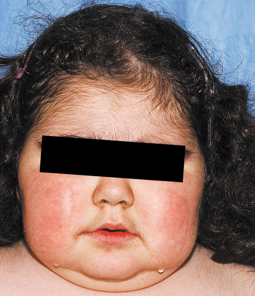 Cushing Syndrome Children