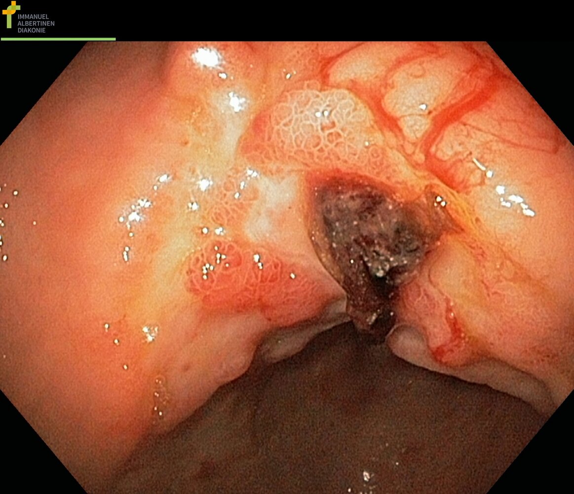 Gastric Ulcer Endoscopy