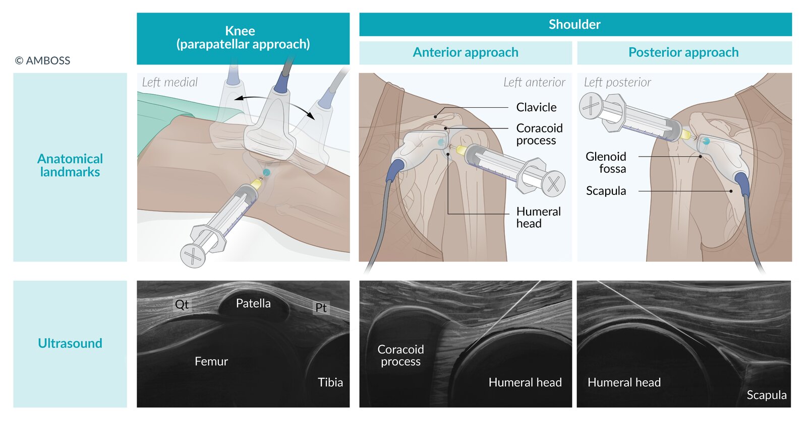 How To Do Arthrocentesis Of Knee