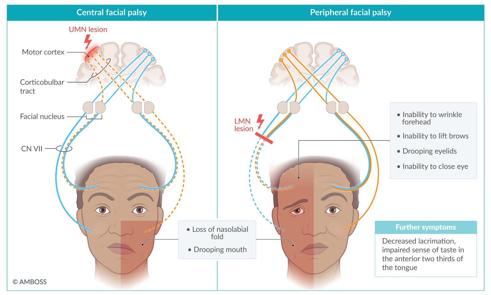 Upper And Lower Motor Neuron Lesion Nerve Block - Infoupdate.org
