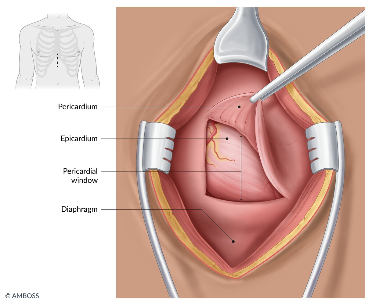 Pericardial Window Pericardiocentesis Wikipedia