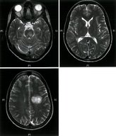 Multiple sclerosis - Knowledge @ AMBOSS