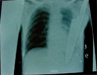 Traumatic hemothorax - Knowledge @ AMBOSS