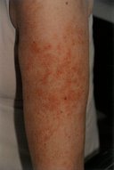 Adult-onset Still disease - Knowledge @ AMBOSS