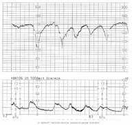 Uterine rupture - Knowledge @ AMBOSS