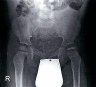 Legg-Calvé-Perthes disease - Knowledge @ AMBOSS