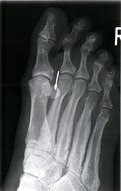 Toe deformities - Knowledge @ AMBOSS