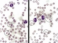 Erythrocyte morphology and hemoglobin - Knowledge @ AMBOSS