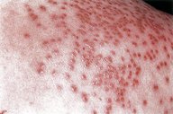 Herpes simplex virus infections - Knowledge @ AMBOSS