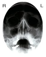 Sinusitis - Knowledge @ AMBOSS