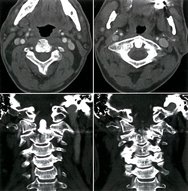 Vertebral injuries - Knowledge @ AMBOSS