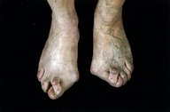 Toe deformities - Knowledge @ AMBOSS