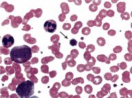 Chronic myeloid leukemia - Knowledge @ AMBOSS