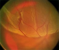 Retinal detachment - Knowledge @ AMBOSS