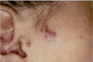 Sarcoidosis - Knowledge @ AMBOSS