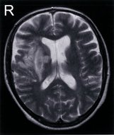 Option 2: Hemorrhagic stroke - Knowledge @ AMBOSS