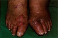 Gout and hyperuricemia - Knowledge @ AMBOSS