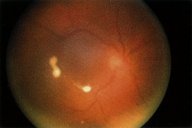 Eye pain and red eye - Knowledge @ AMBOSS