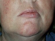 Facial nerve palsy - Knowledge @ AMBOSS