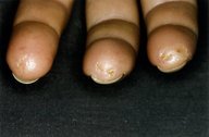 Systemic sclerosis - Knowledge @ AMBOSS