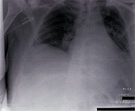 Atelectasis - Knowledge @ AMBOSS