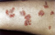 Blistering skin diseases - Knowledge @ AMBOSS