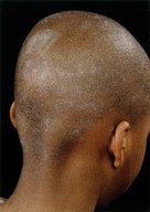 Overview of fungal infections - Knowledge @ AMBOSS