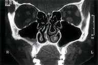 Nasal turbinate hypertrophy - Knowledge @ AMBOSS