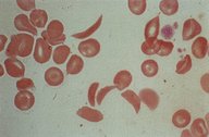 Erythrocyte morphology and hemoglobin - Knowledge @ AMBOSS