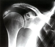 Soft tissue lesions of the shoulder - Knowledge @ AMBOSS