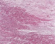 Myocardial infarction - Knowledge @ AMBOSS