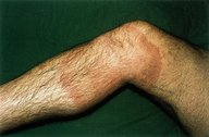 Lyme disease - Knowledge @ AMBOSS