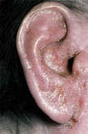 Otitis externa - Knowledge @ AMBOSS