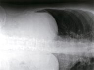 Peptic ulcer disease - Knowledge @ AMBOSS