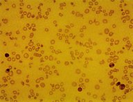 Erythrocyte morphology and hemoglobin - Knowledge @ AMBOSS