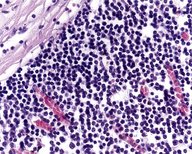 Chronic lymphocytic leukemia - Knowledge @ AMBOSS