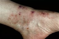 Principles of dermatology - Knowledge @ AMBOSS