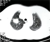 Lung cancer - Knowledge @ AMBOSS