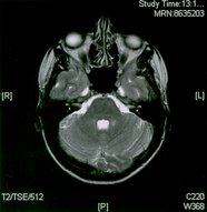Multiple sclerosis - Knowledge @ AMBOSS