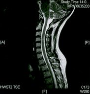 Multiple sclerosis - Knowledge @ AMBOSS