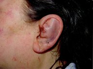 Ear injuries - Knowledge @ AMBOSS